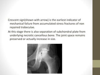 Avascular necrosis and Osteochondritis | PPTX