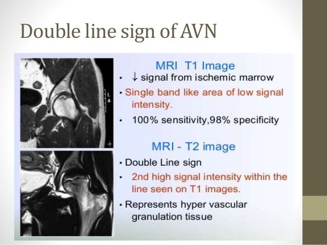 Avascular necrosis and Osteochondritis