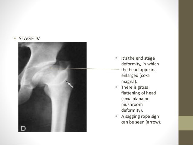 Avascular necrosis and Osteochondritis