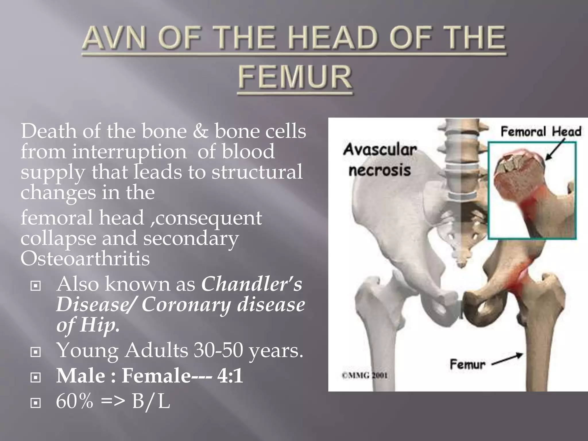 Avascular necrosis | PPTX