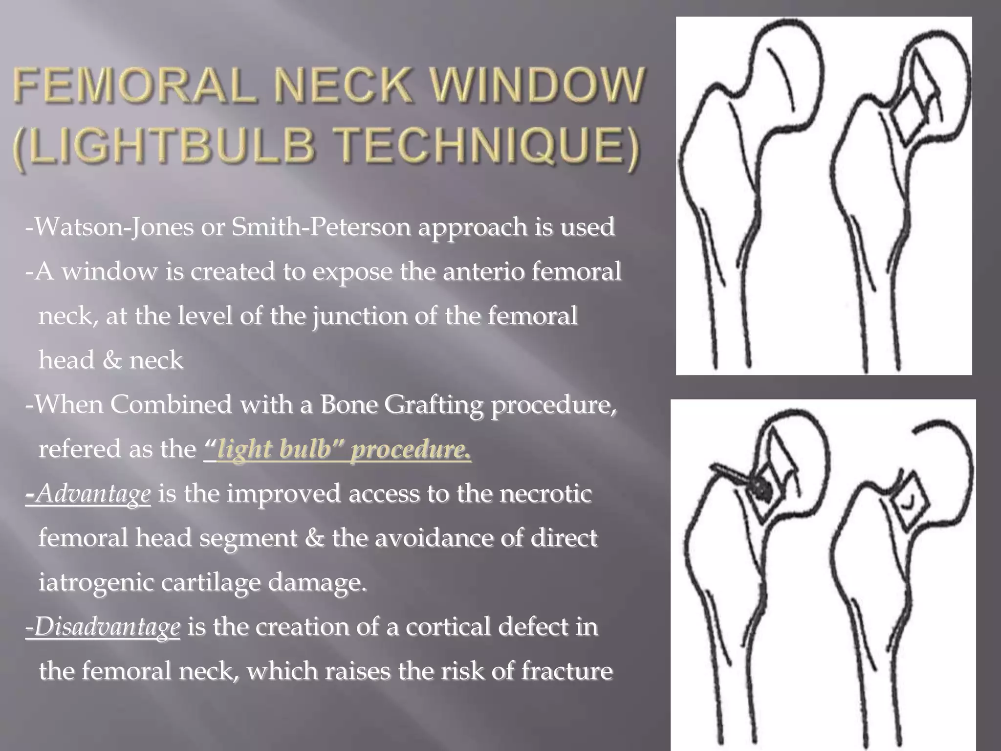 Avascular necrosis | PPTX
