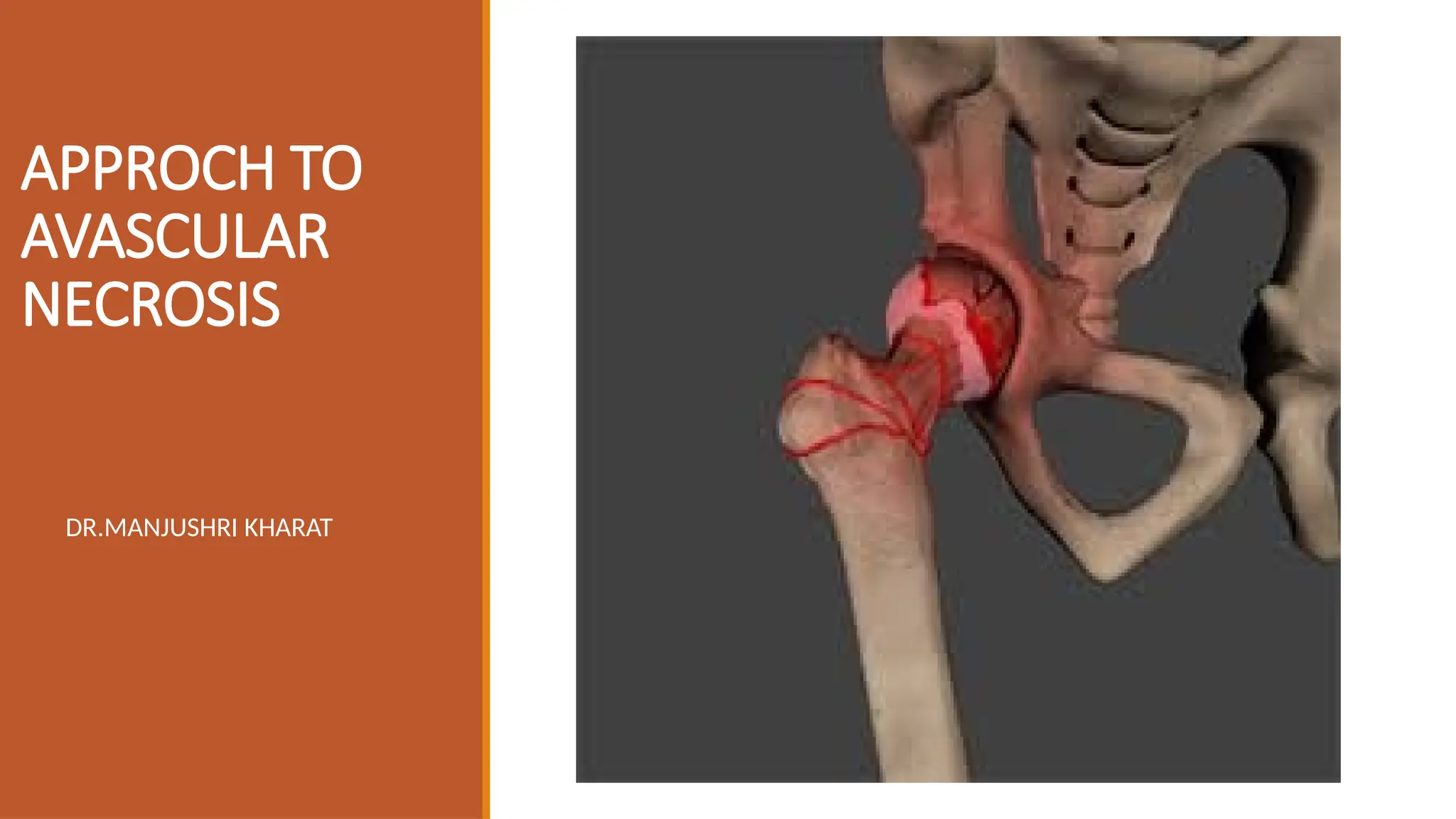 approach to avascular necrosis by Dr.manjushree | PPTX