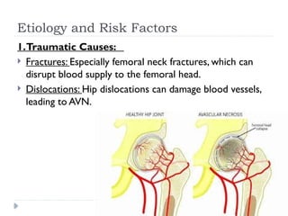 Avascular Necrosis (AVN).pptx................ | PPTX | Bone and Joint ...