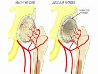 Avascular Necrosis (AVN).pptx................ | PPTX | Bone and Joint ...