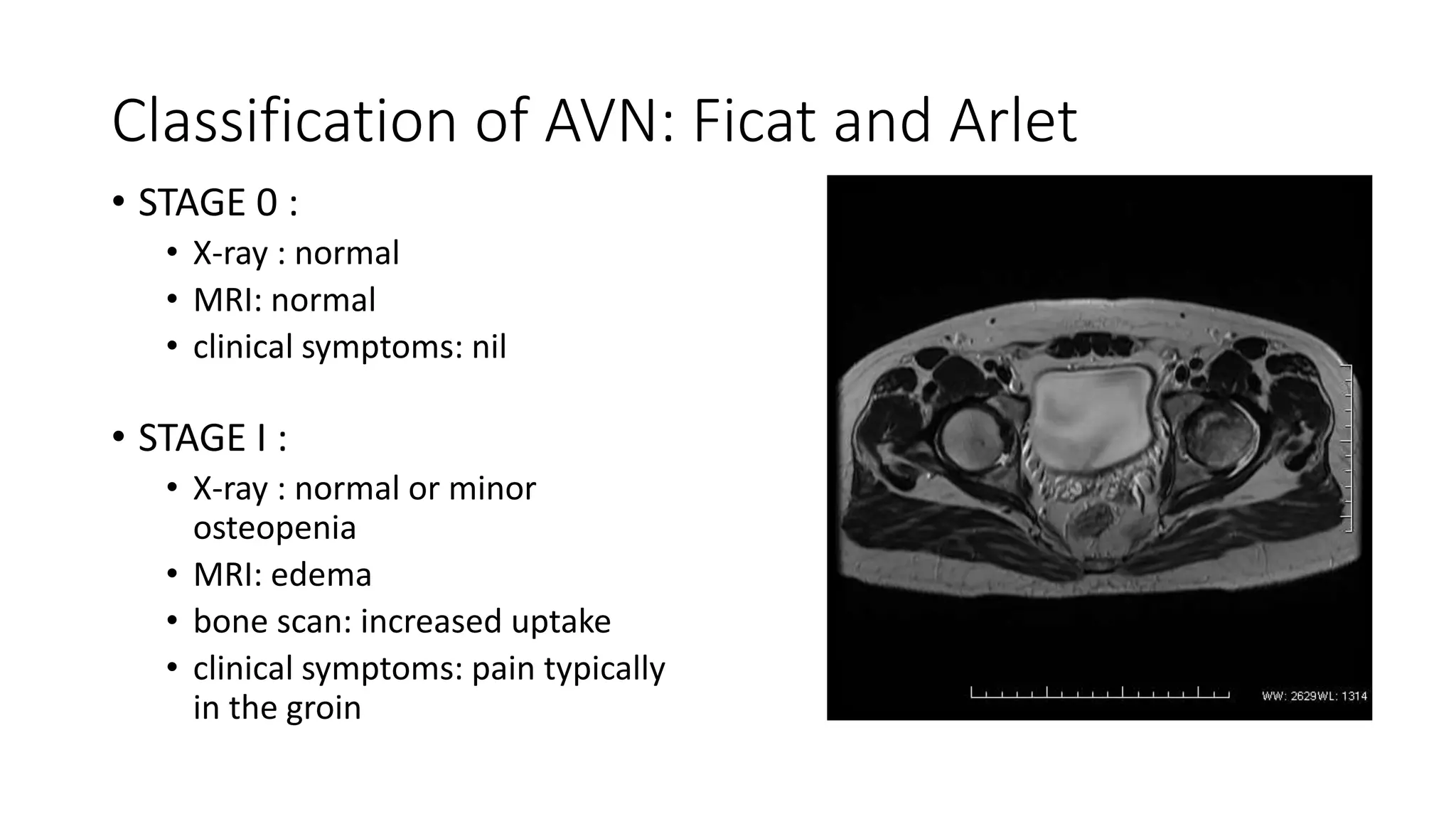 Avascular necrosis of Hip - treatment modalities and current concepts.pptx