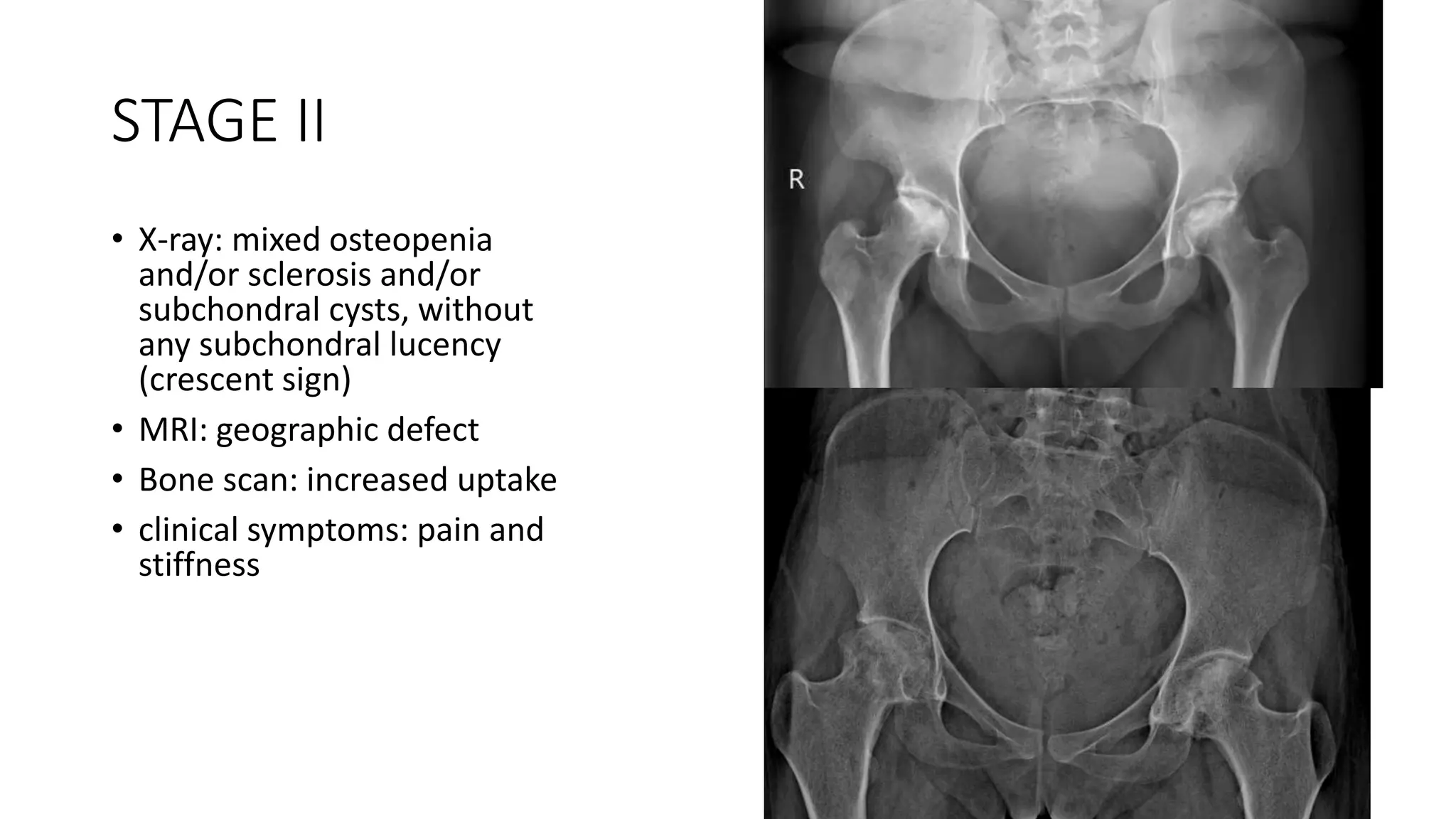 Avascular necrosis of Hip - treatment modalities and current concepts.pptx