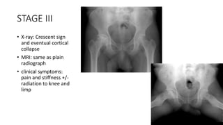 Avascular necrosis of Hip - treatment modalities and current concepts.pptx