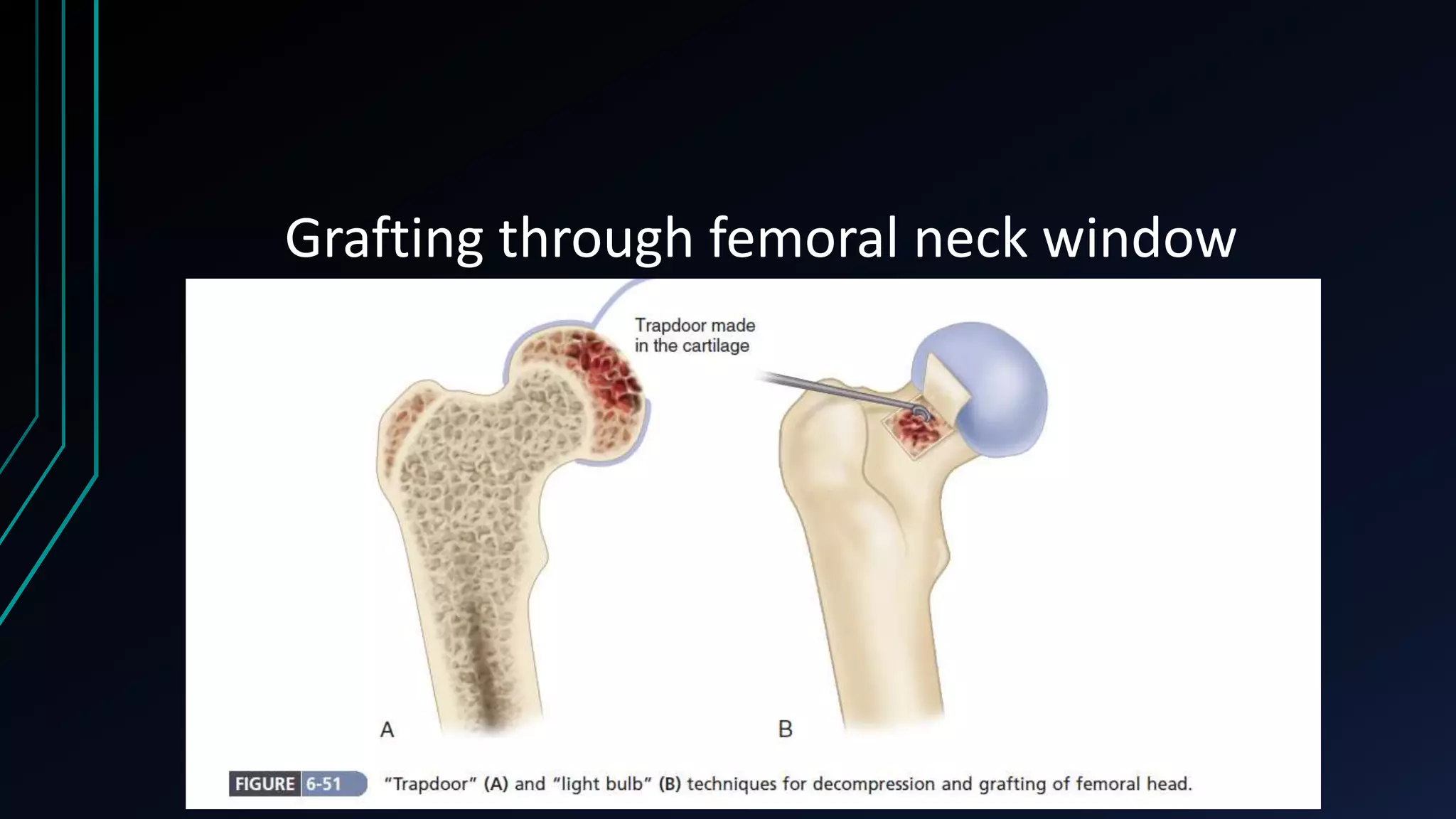 Avascular necrosis of femoral head | PPTX