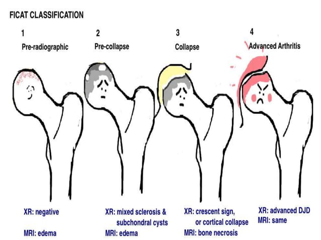 Avascular Necrosis Of Femoral Head.pptx