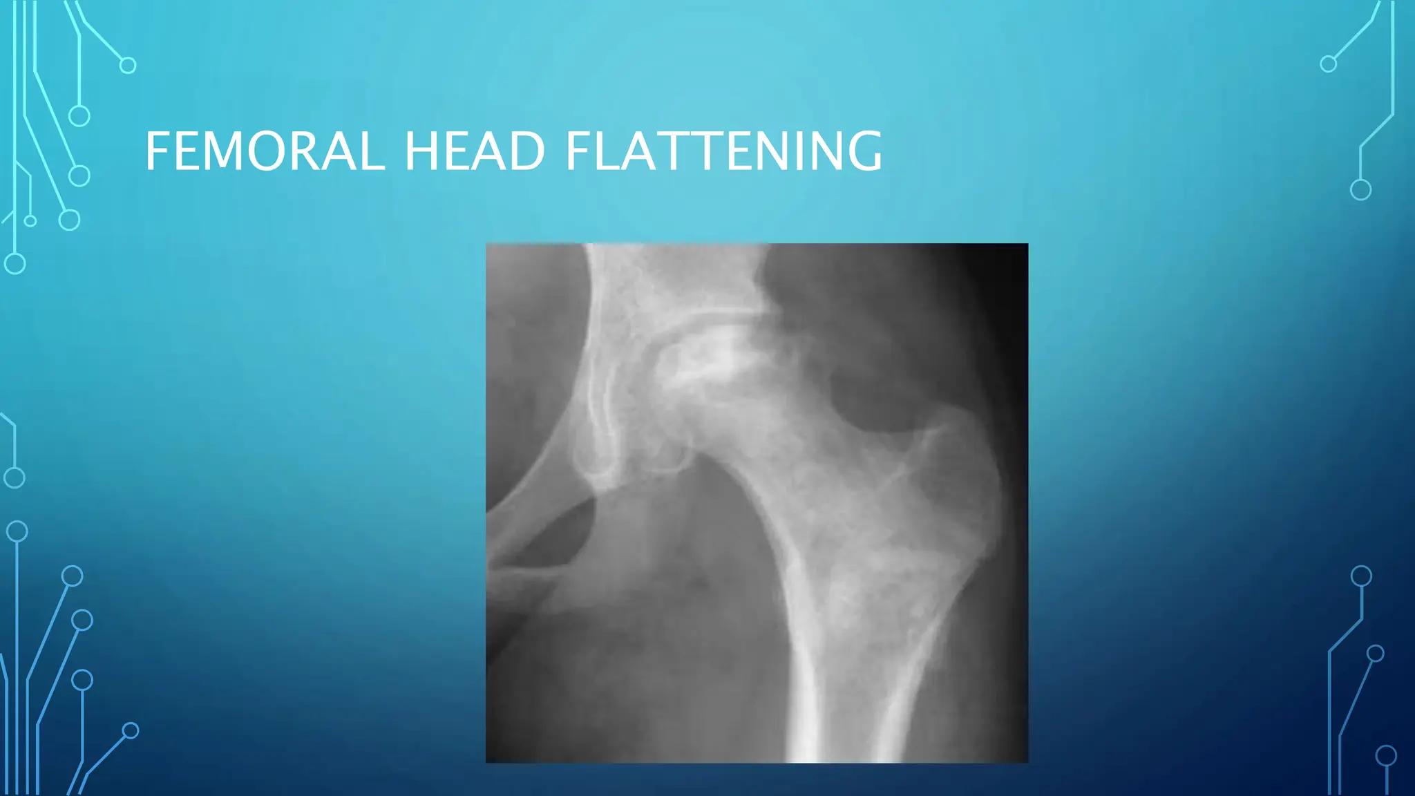 Avascular necrosis of head of femur.pptx