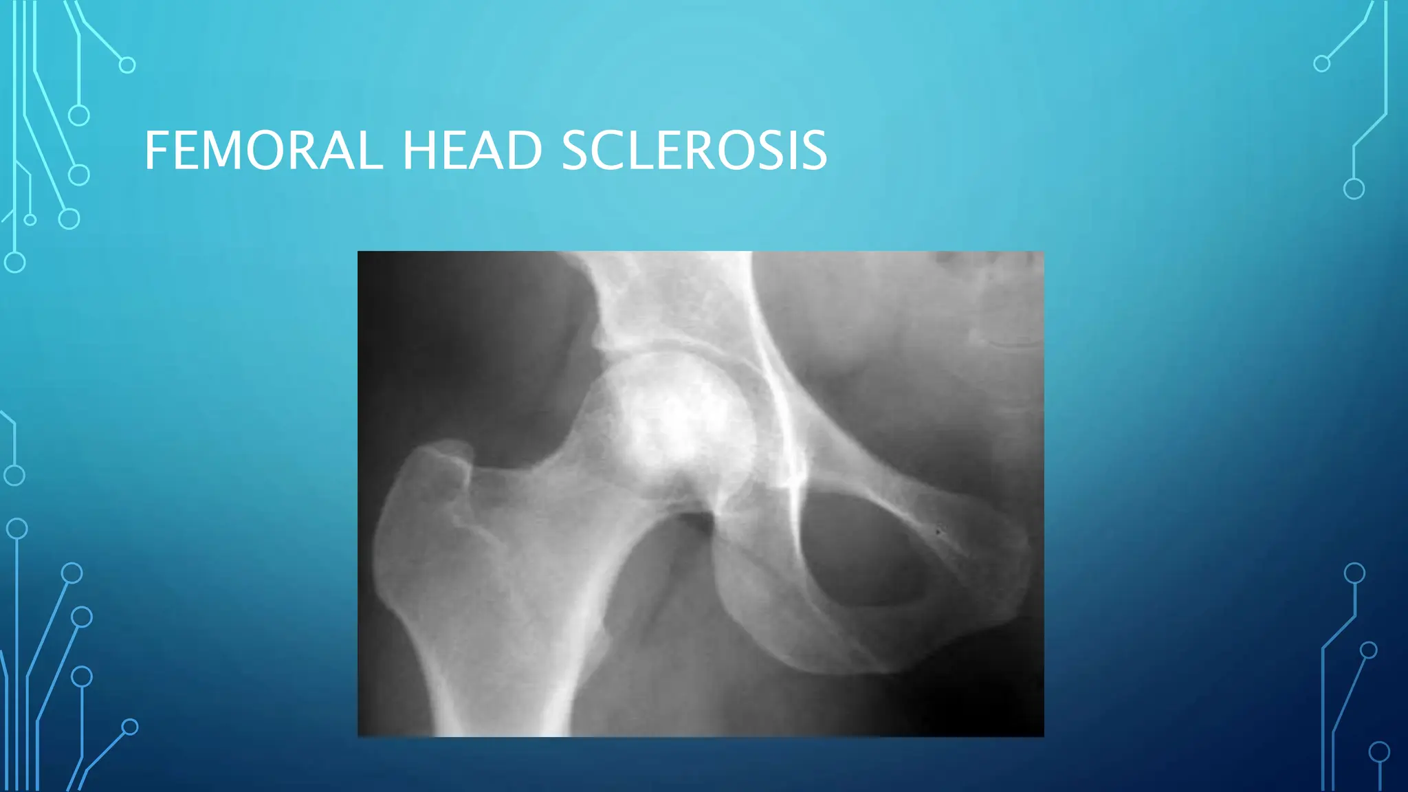 Avascular necrosis of head of femur.pptx