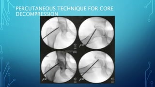 Avascular necrosis of head of femur.pptx | Bone and Joint Conditions ...