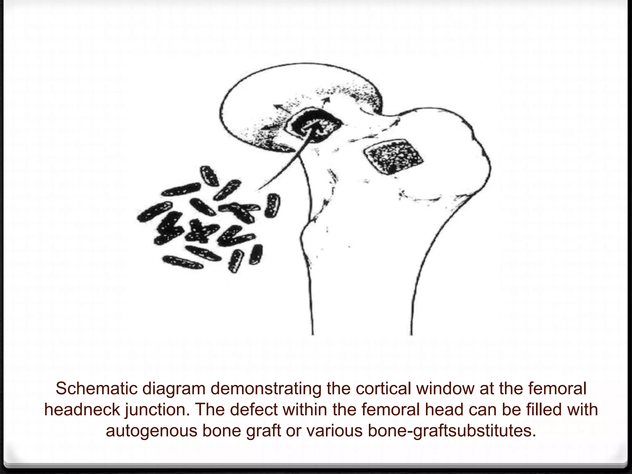 Avascular necrosis of femur head IN DETAIL | PPT