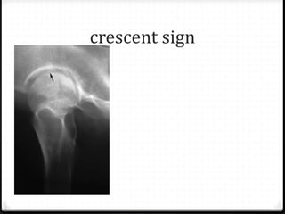 Avascular necrosis of femur head IN DETAIL | PPT