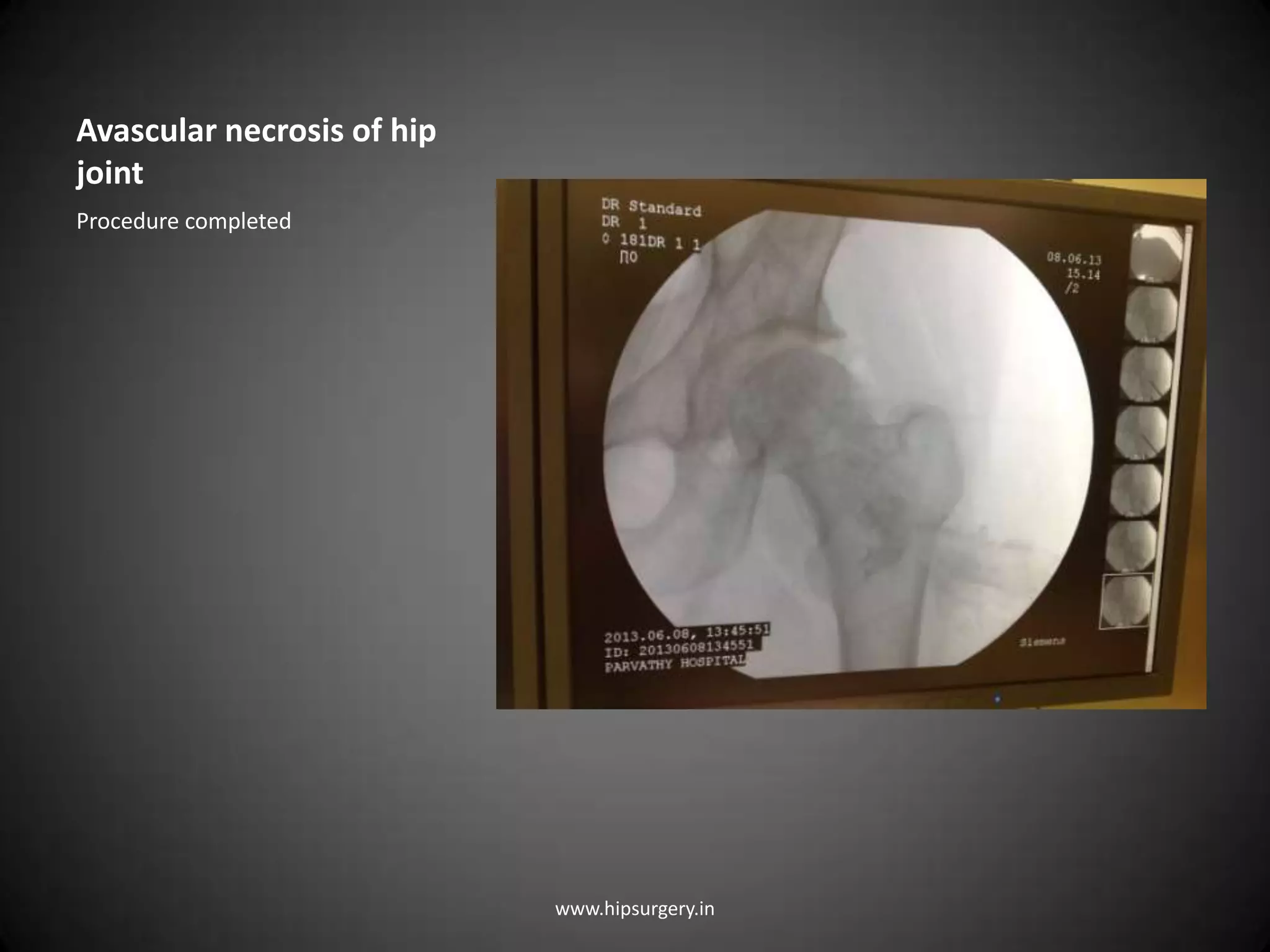 Avascular necrosis of hip joint | PPTX