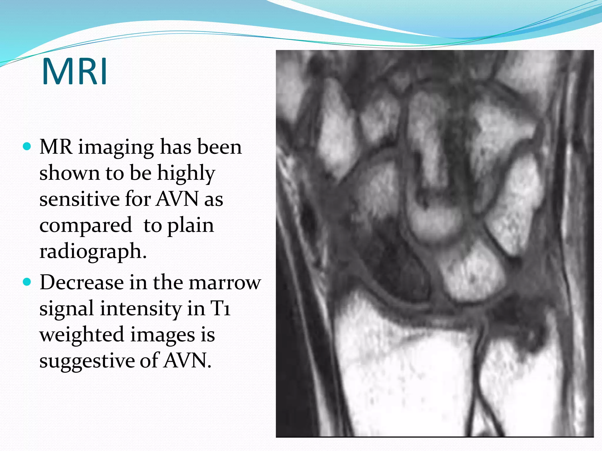 Avascular necrosis of scaphoid | PPTX