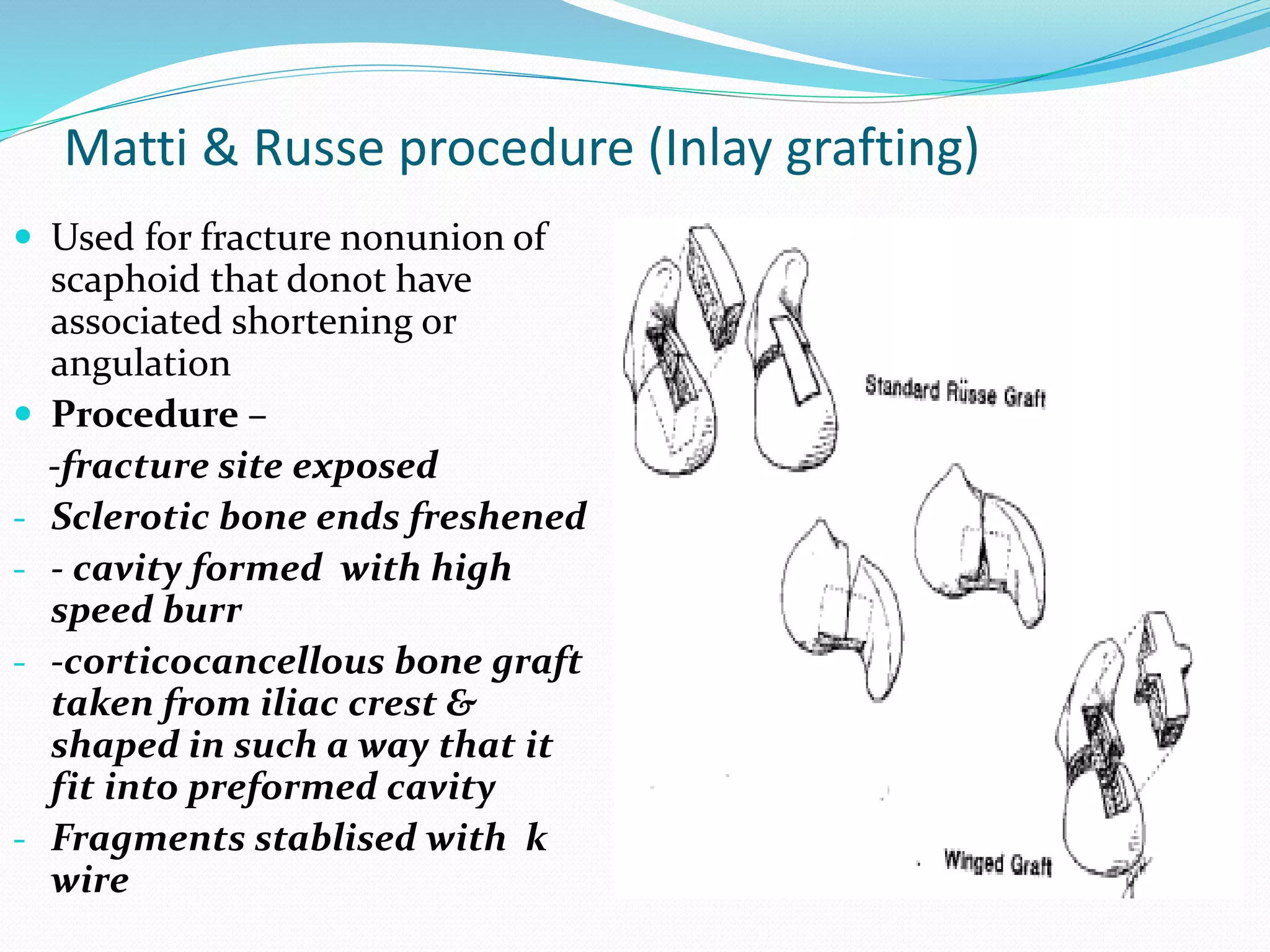 Avascular necrosis of scaphoid | PPTX