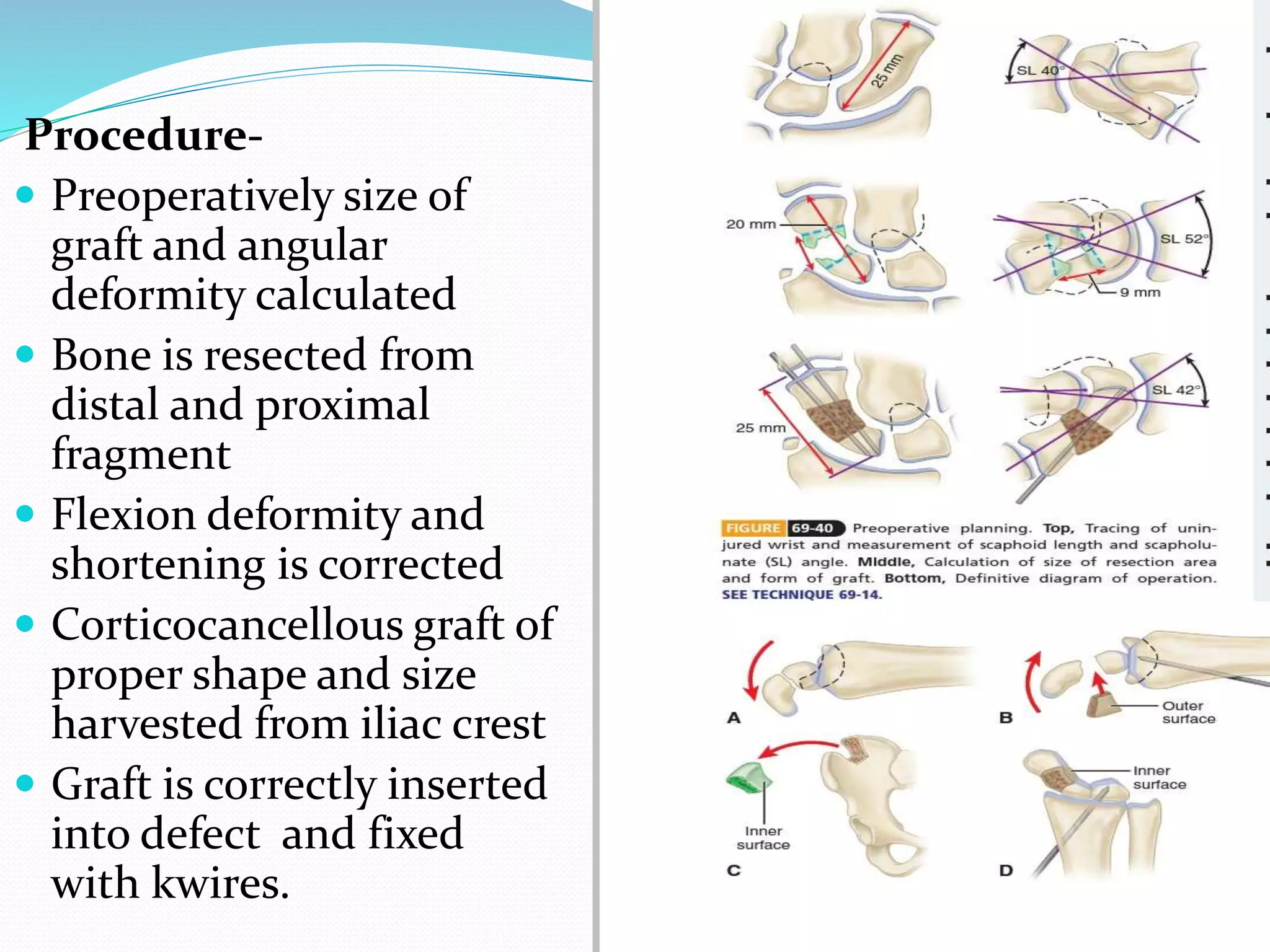 Avascular necrosis of scaphoid | PPTX
