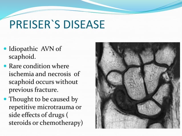 Avascular necrosis of scaphoid | PPTX | Death, Injury, or Military ...