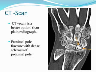 Avascular necrosis of scaphoid | PPTX