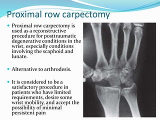 Avascular necrosis of scaphoid | PPTX