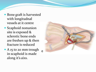 Avascular necrosis of scaphoid | PPTX