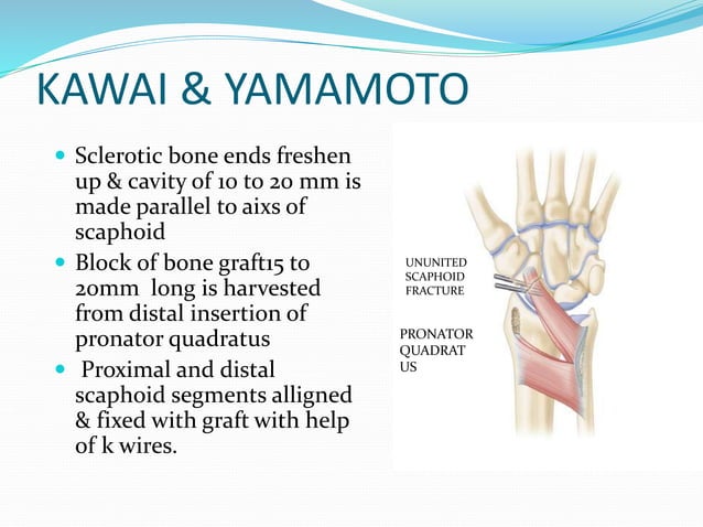 Avascular necrosis of scaphoid