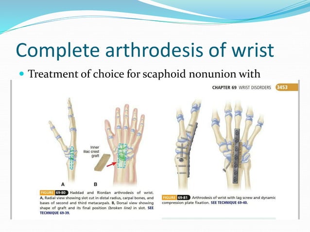 Avascular necrosis of scaphoid