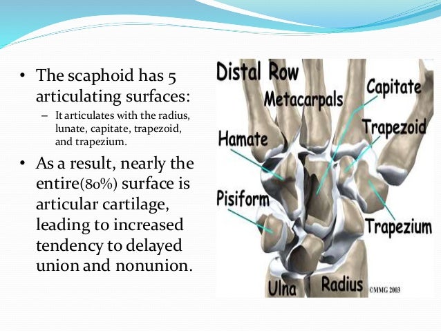 Avascular necrosis of scaphoid