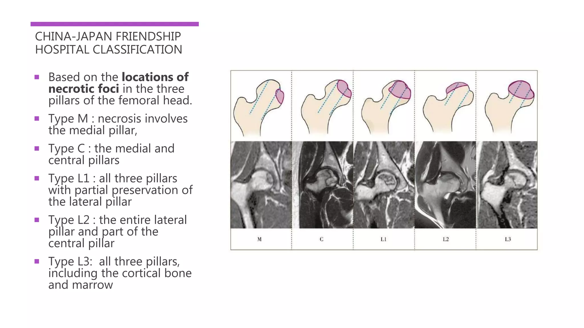 Avascular necrosis of the hip | PPTX