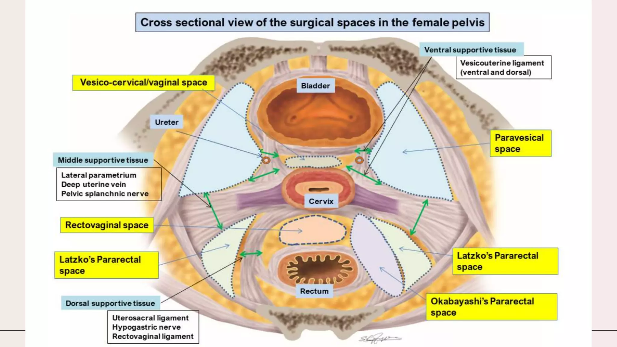 Avascular spaces in radical hysterectomy.pptx