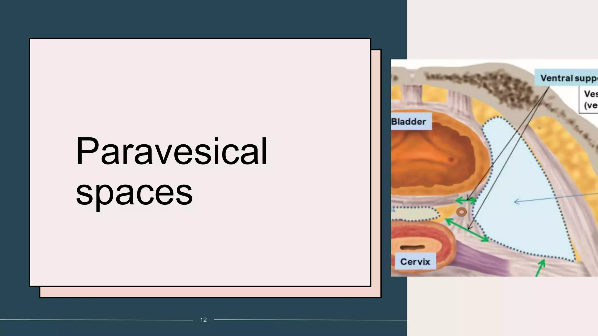 Avascular spaces in radical hysterectomy.pptx