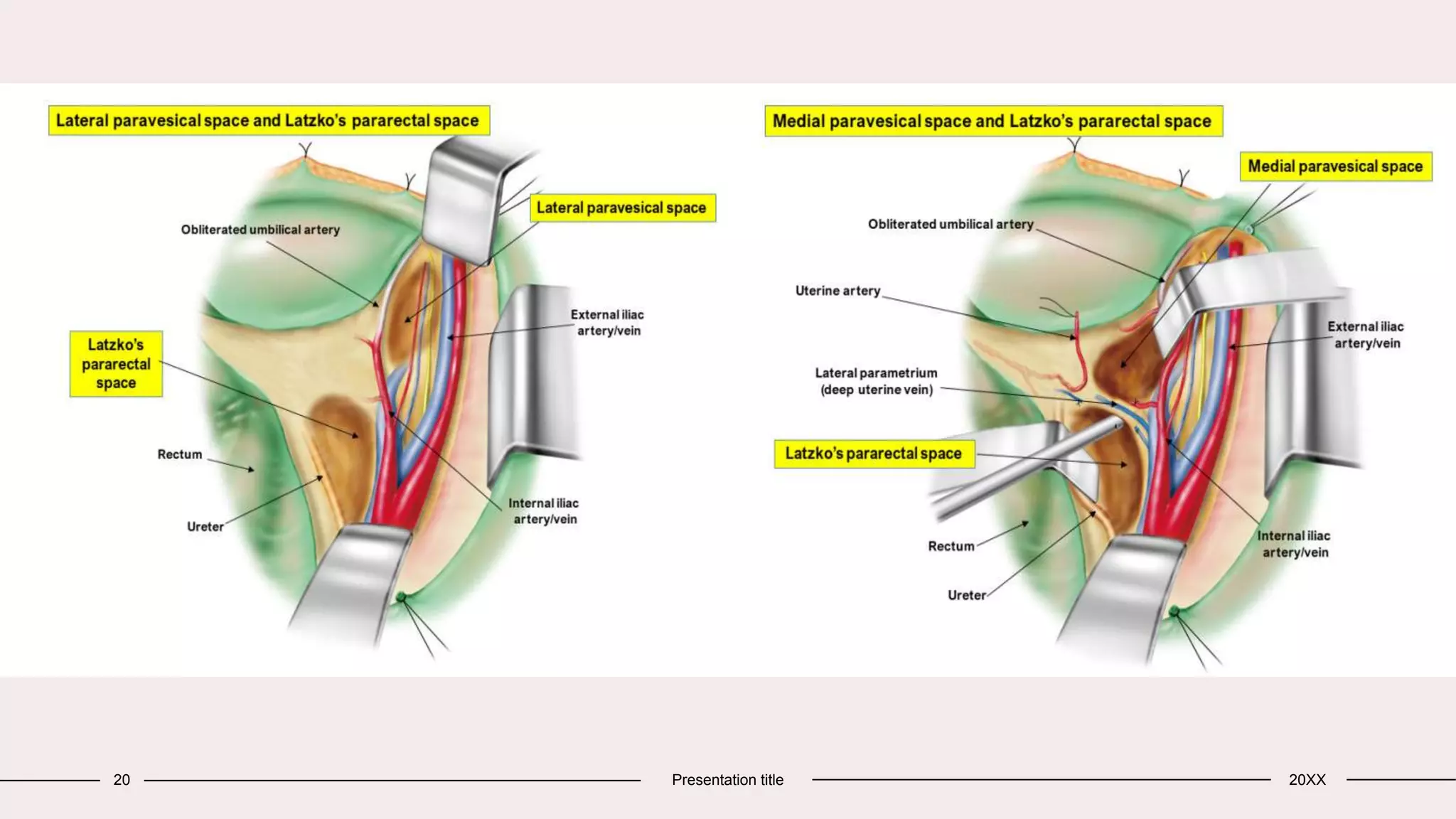 Avascular spaces in radical hysterectomy.pptx