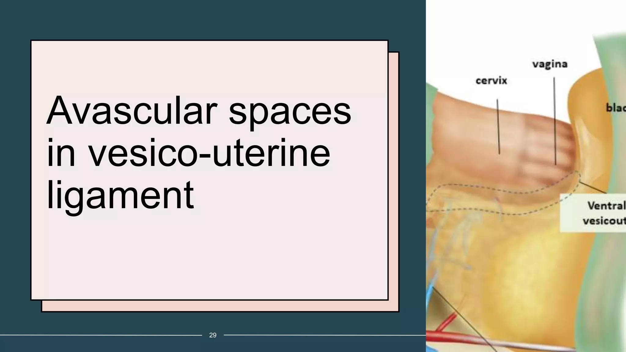 Avascular spaces in radical hysterectomy.pptx