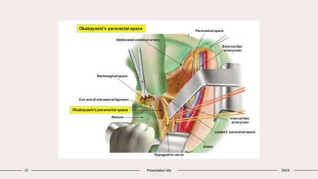 Avascular spaces in radical hysterectomy.pptx