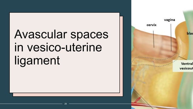 Avascular spaces in radical hysterectomy.pptx