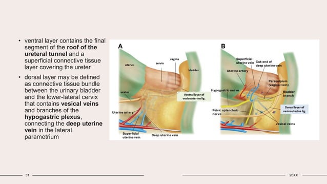 Avascular spaces in radical hysterectomy.pptx
