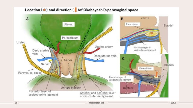 Avascular spaces in radical hysterectomy.pptx