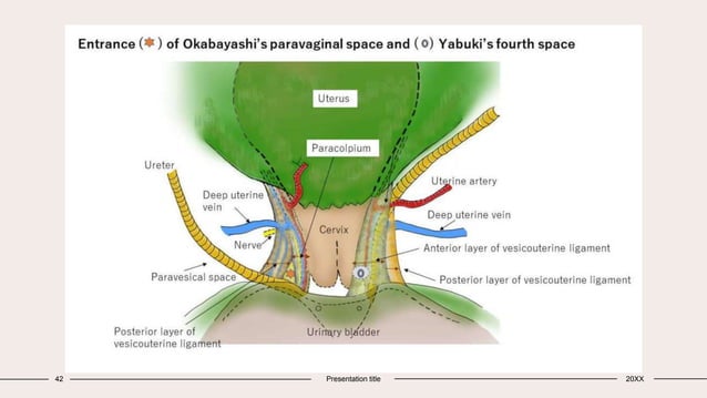 Avascular spaces in radical hysterectomy.pptx