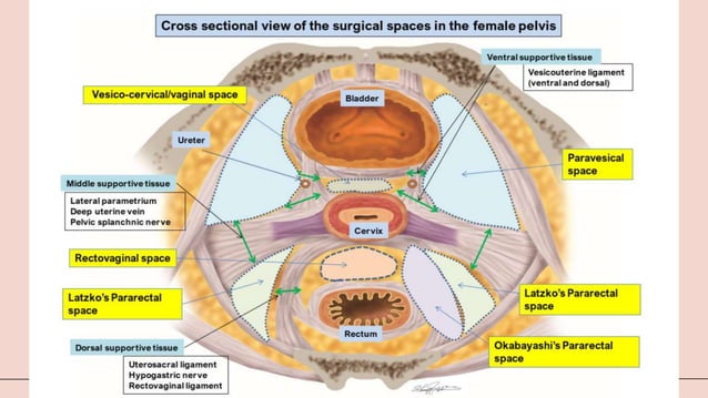 Avascular spaces in radical hysterectomy.pptx