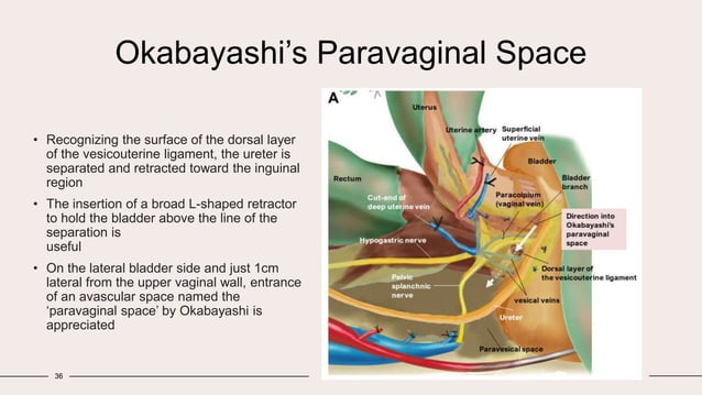 Avascular spaces in radical hysterectomy.pptx