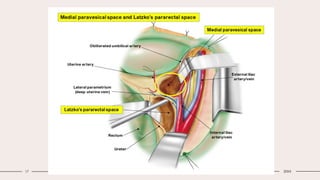 Avascular spaces in radical hysterectomy.pptx
