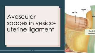 Avascular spaces in radical hysterectomy.pptx