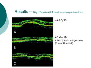 Avastin for Choroidal Neovascularization 2/2 ARMD | PPT