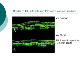 Avastin for Choroidal Neovascularization 2/2 ARMD | PPT
