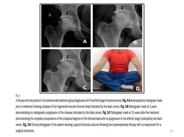 Avasular necrosis – medical management-1.pptx