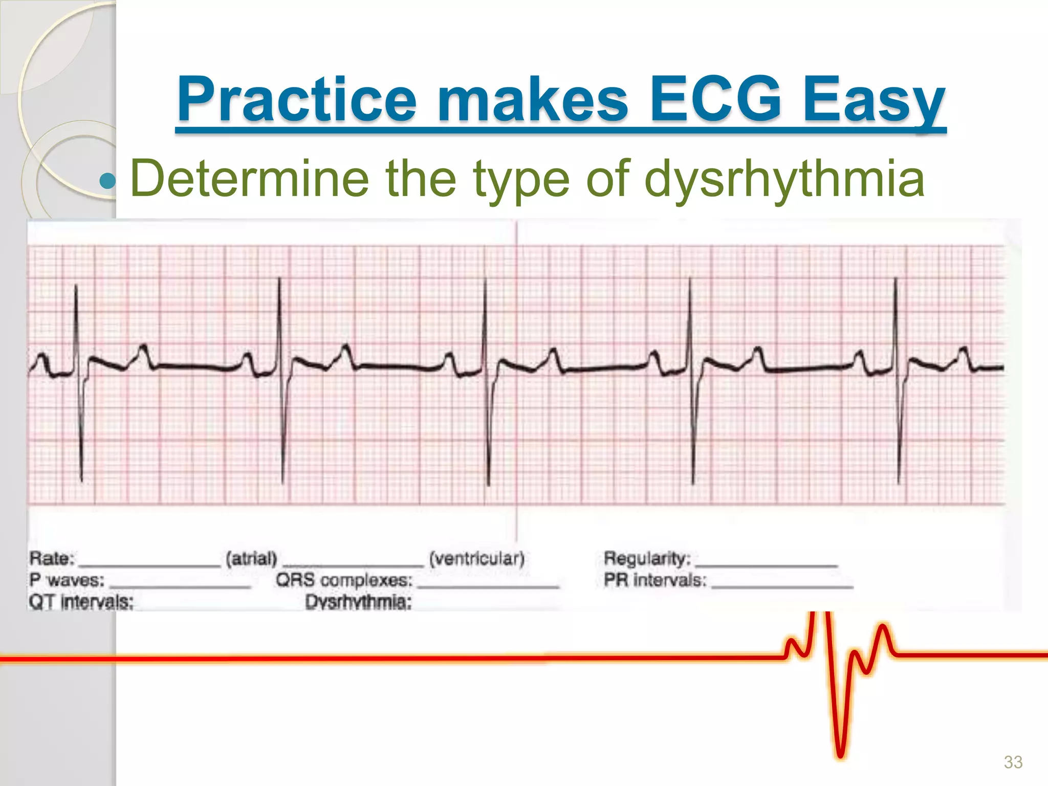 AV block ecg analysis | PPTX