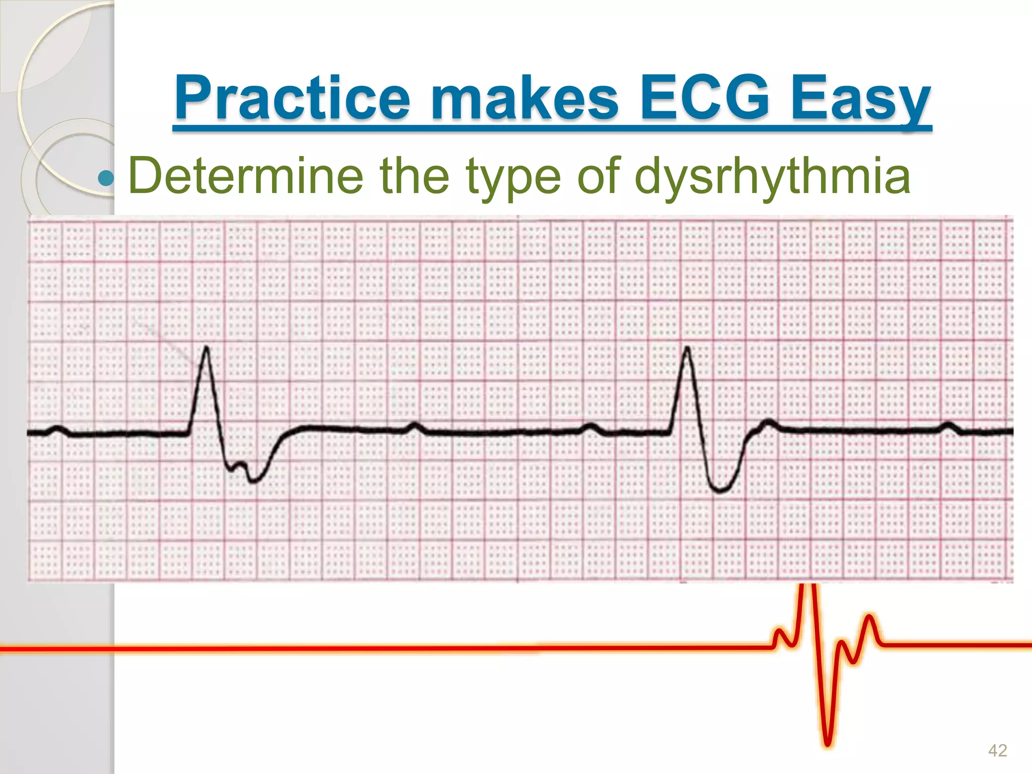 AV block ecg analysis | PPTX