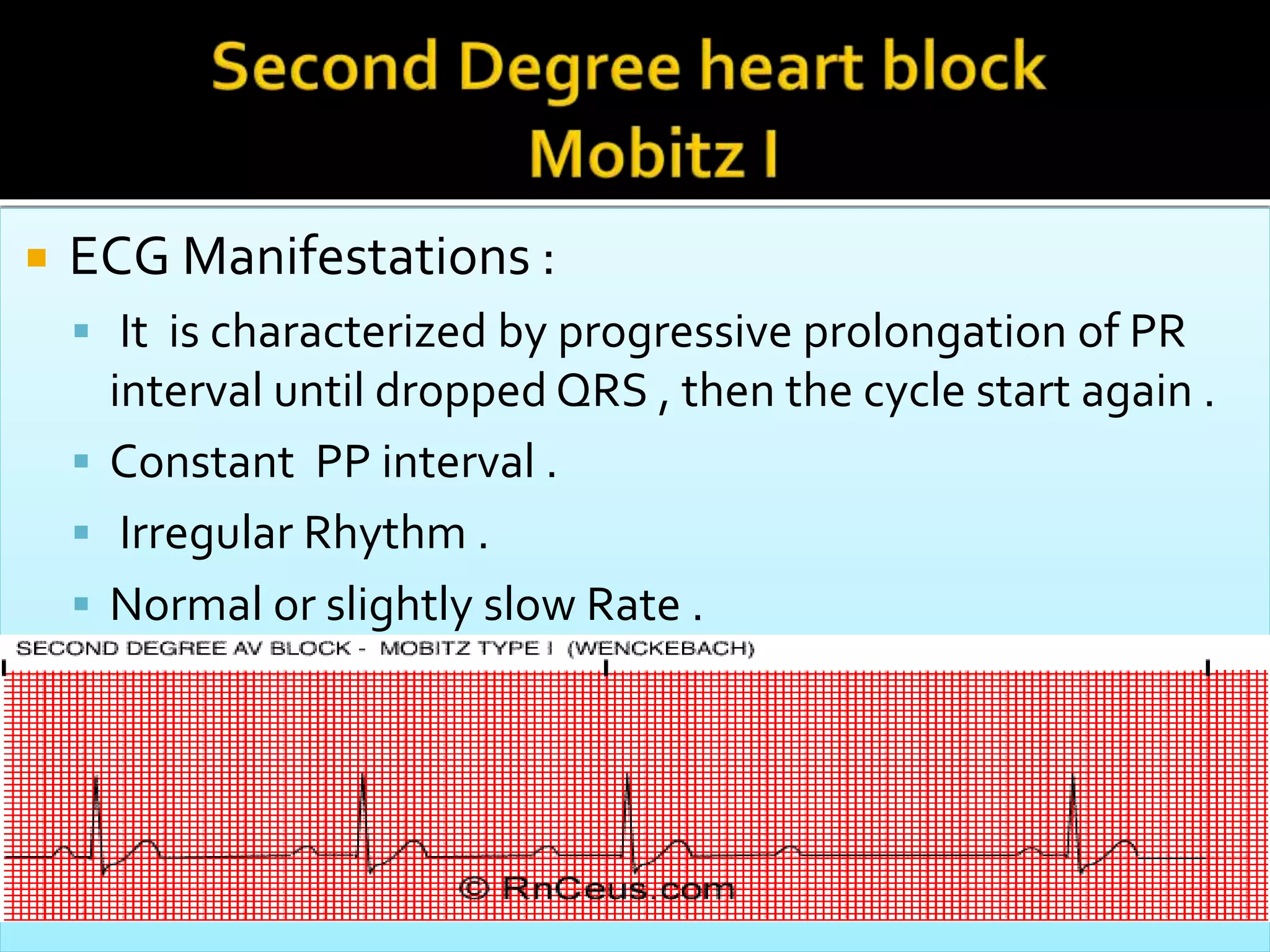 Heart block | PPTX