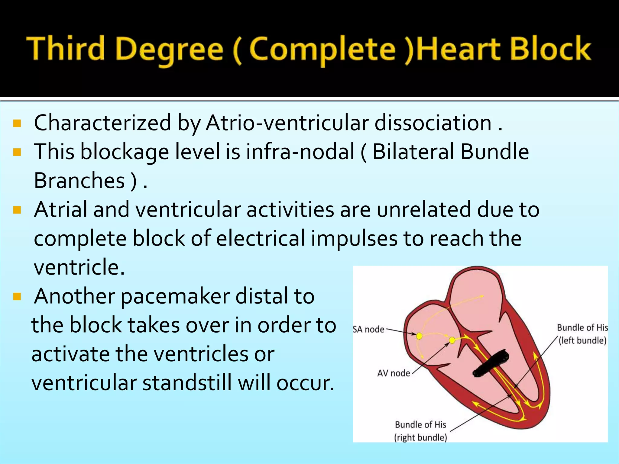 Heart block | PPTX